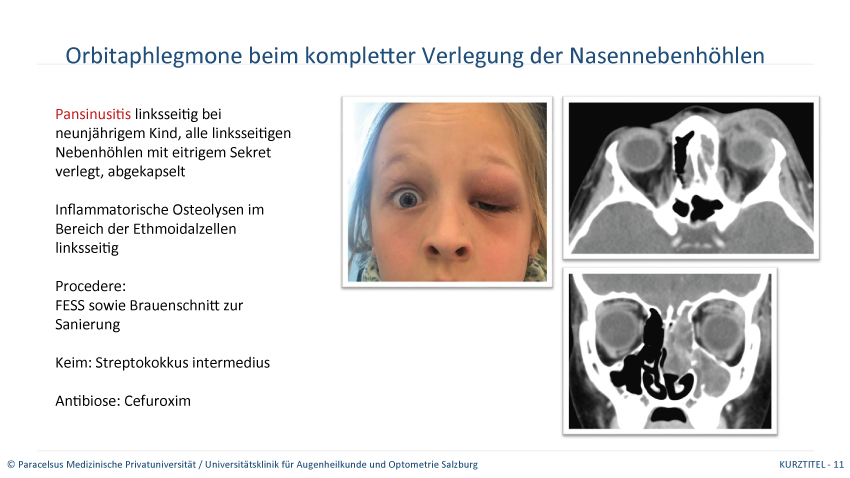 Orbitaphlegmone beim kompletter Verlegung der Nasennebenhöhlen ...