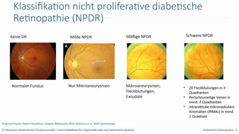 Klassifikation nicht proliferative diabetische Retinopathie (NPDR ...